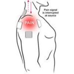 Do TENS Units Work?